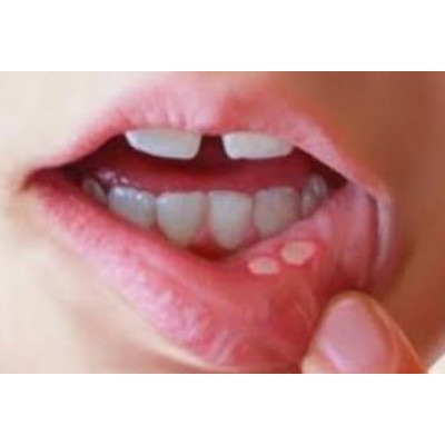 แผลในช่องปาก Aphthous ulcer